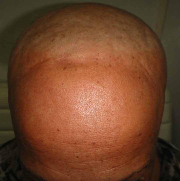 Comprehensive Overview and Treatment Update on Hair Loss