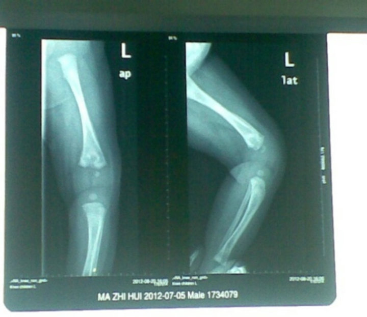 A special and rare case with osteomyelitis: A case report