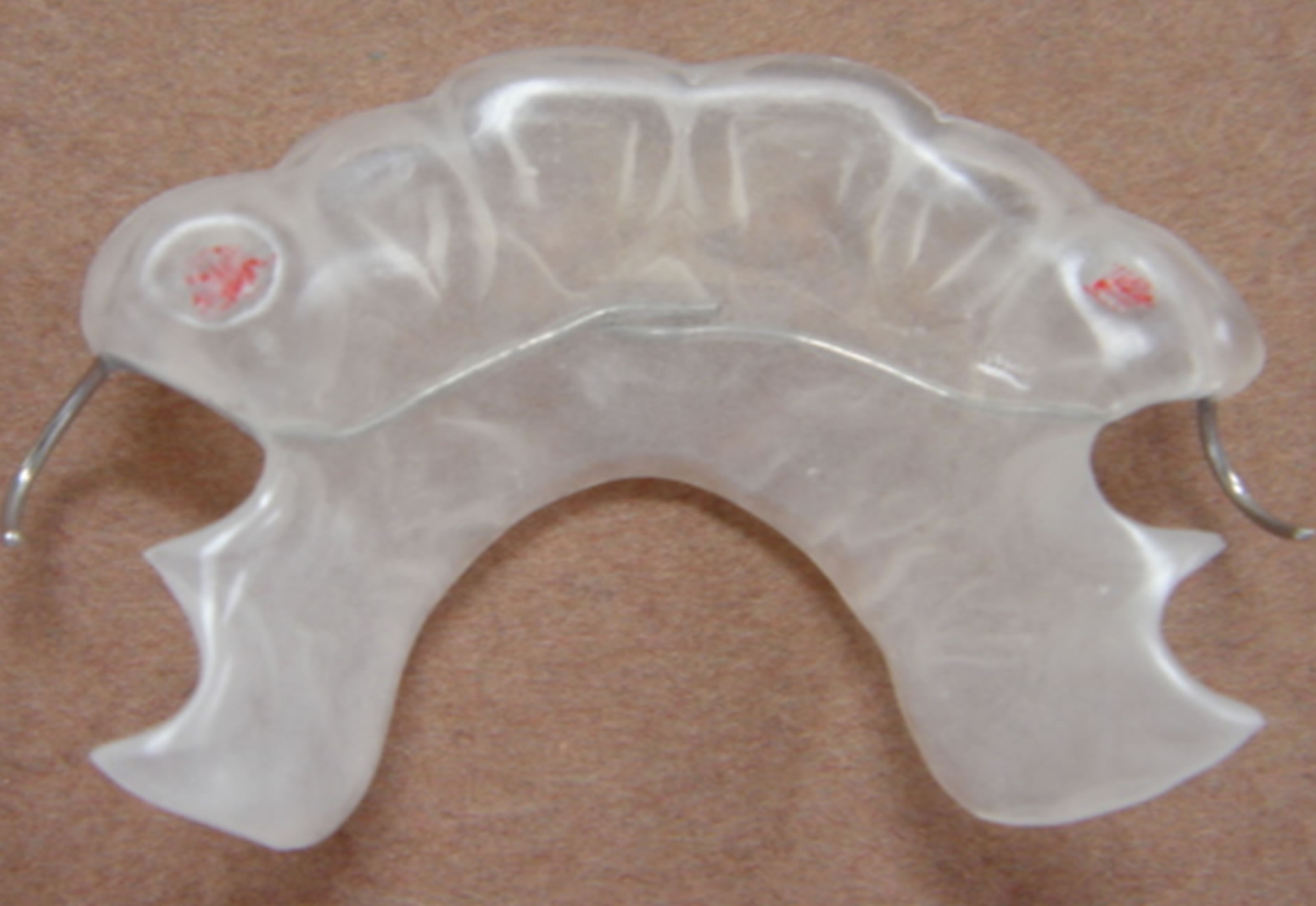 A preliminary study on the treatment of bruxism by biofeedback therapy