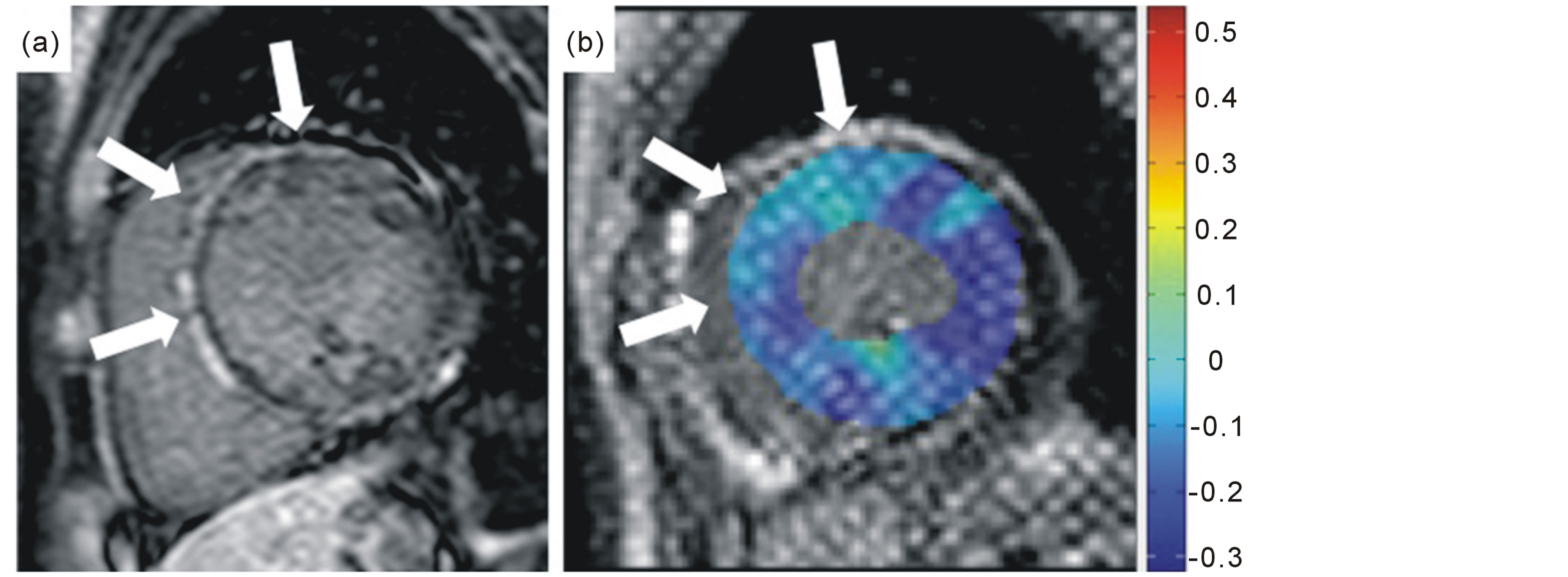 The Detectability for the Myocardial Fibrosis by Tagging Imaging on ...