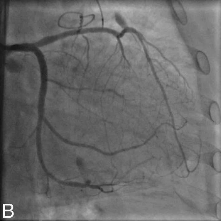 Retrograde percutaneous coronary intervention via critically ...