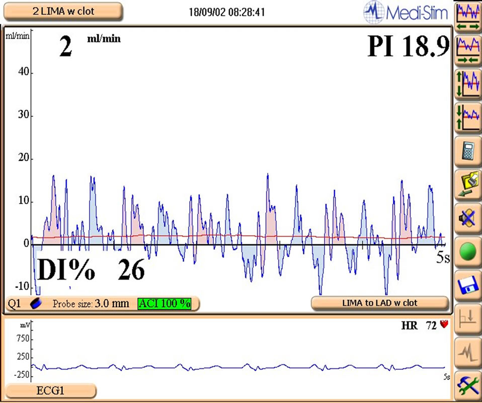 Graft Quality Control with the Traditional Roller Pump Flow Measurement ...