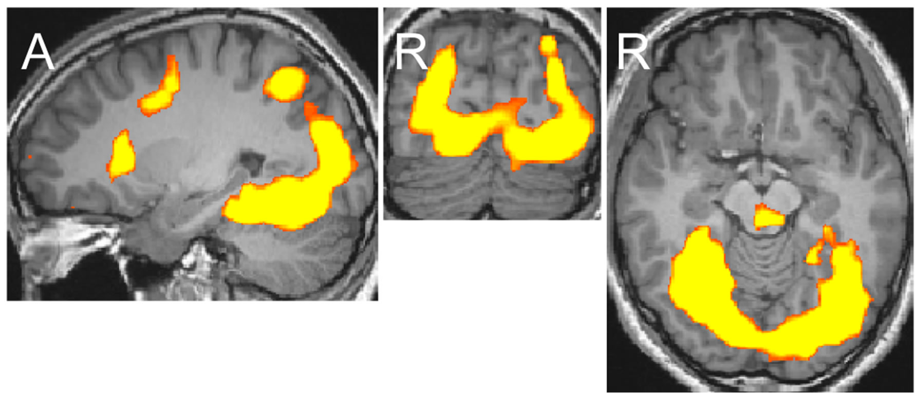 Eye Movements Provide Inhibitory Inputs to the Occipito-Temporal Region