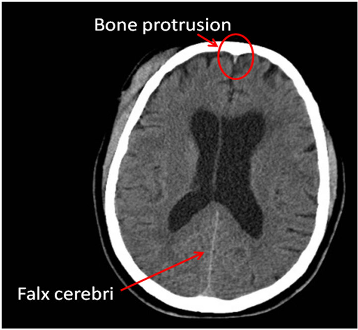 Ideal Midline Detection Using Automated Processing of Brain CT Image
