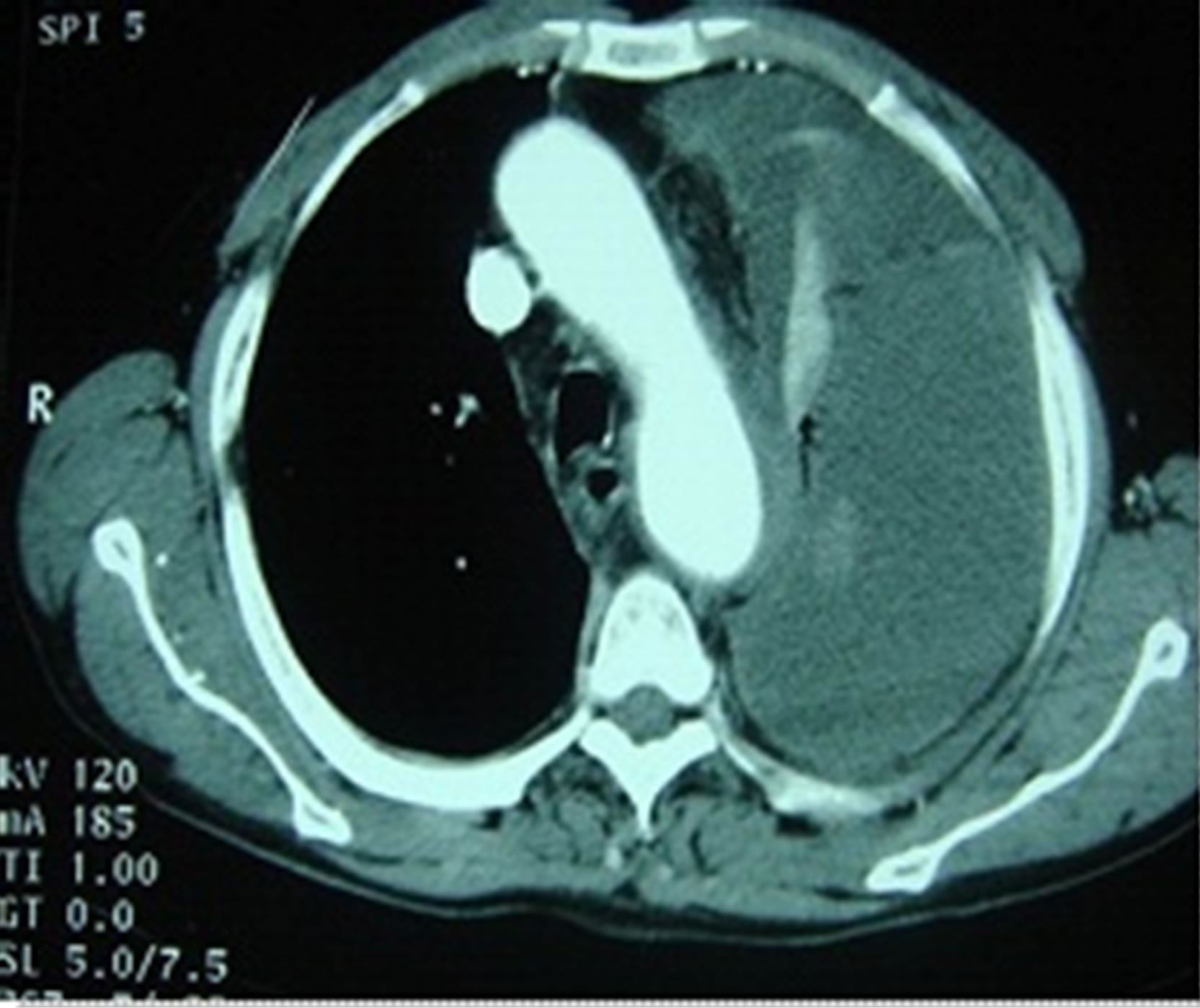 Hemothorax Revealing Aortic Aneurism and Aortic Dissection