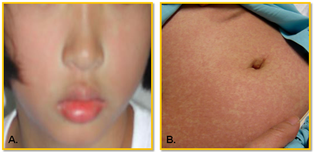 Dengue Vaccines: Challenge and Confrontation