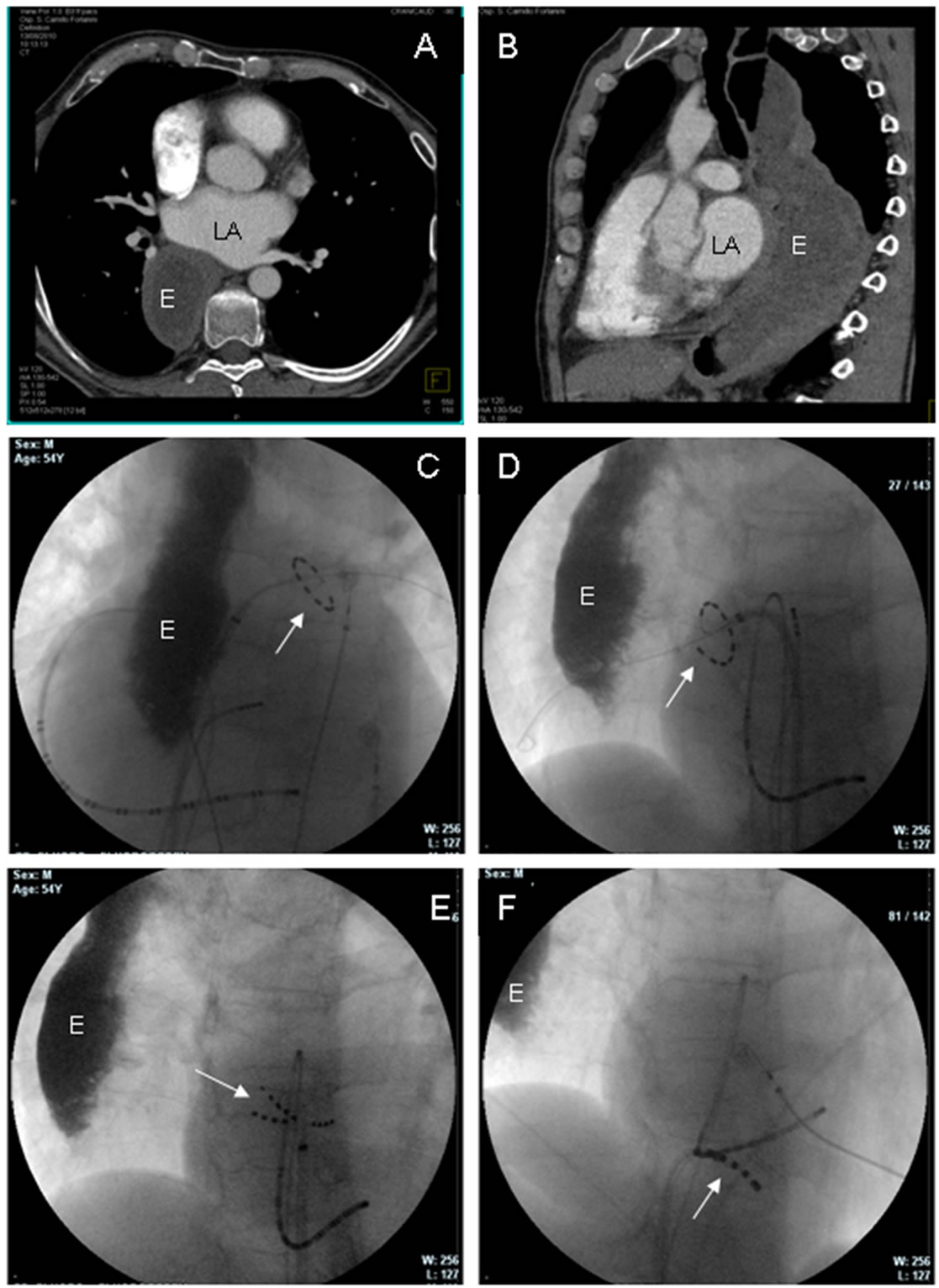 Successful radiofrequency ablation of long-standing persistent atrial ...