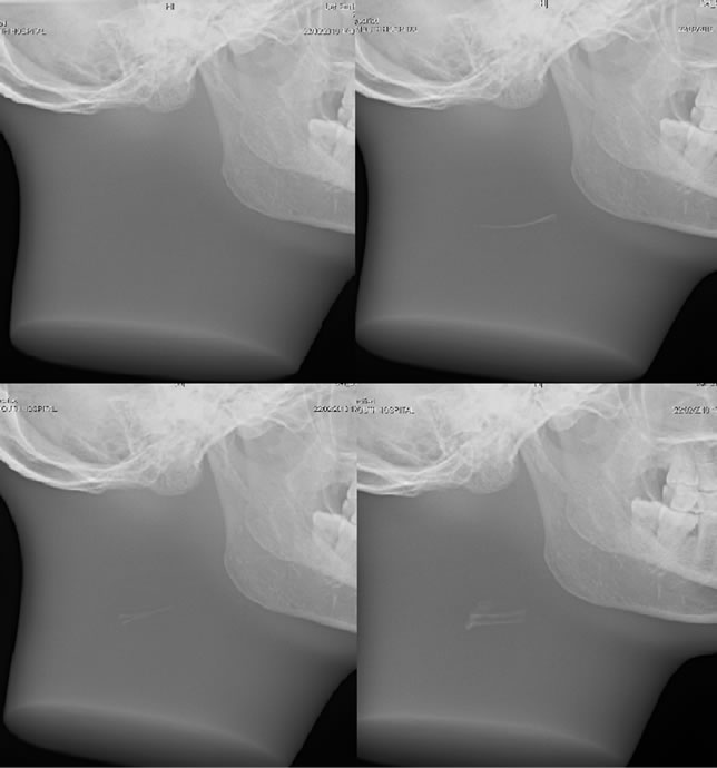 The lateral neck radiograph for an impacted fish bone in the aero ...