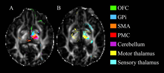 Probabilistic tractography of the posterior subthalamic area in ...