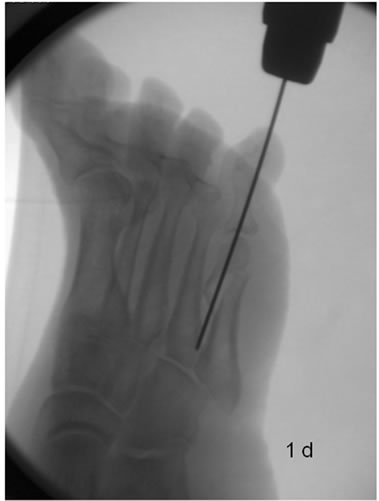 Metatarsal Fracture Reduction And Fixation By Kirschner Wires