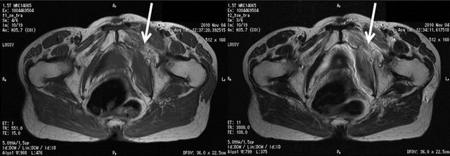 Diagnosis of occult fractures of the ischiopubic rami