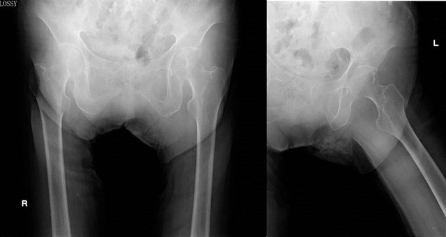 Diagnosis of occult fractures of the ischiopubic rami