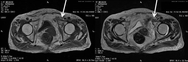 Diagnosis of occult fractures of the ischiopubic rami