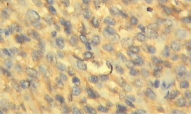 Endometrial stromal sarcoma presenting as multiple primary tumor