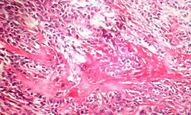Endometrial stromal sarcoma presenting as multiple primary tumor