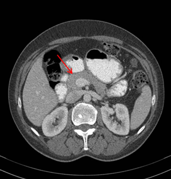 Ectopic (heterotopic) pancreas in the mesentery of the jejunum: Imaging ...