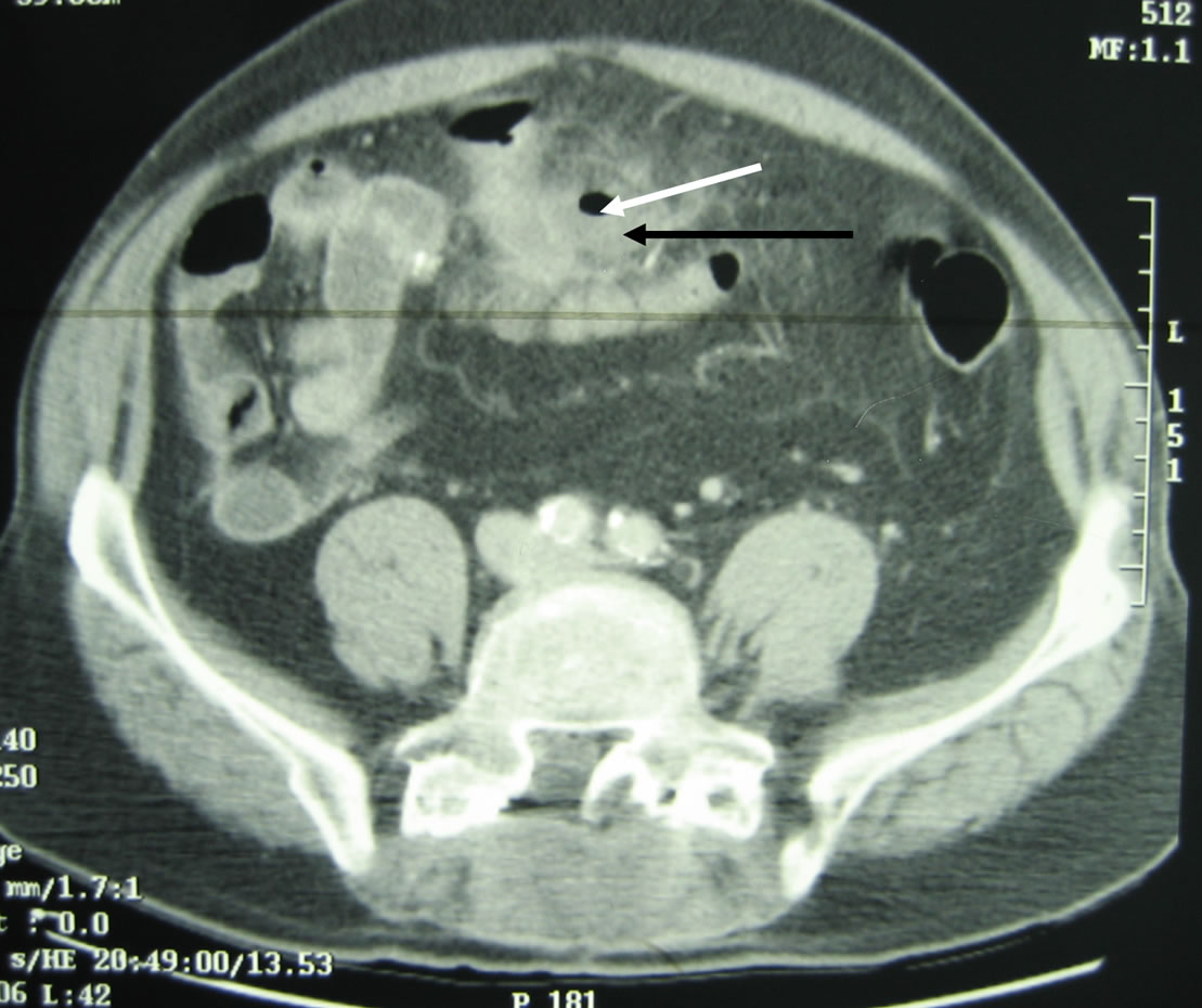 Long Term Survival after Resection of a Small Bowel Metastasis of Lung ...