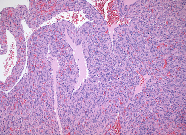 Angiosarcoma of the mandible: Metastasis from a primary tumor of the ...