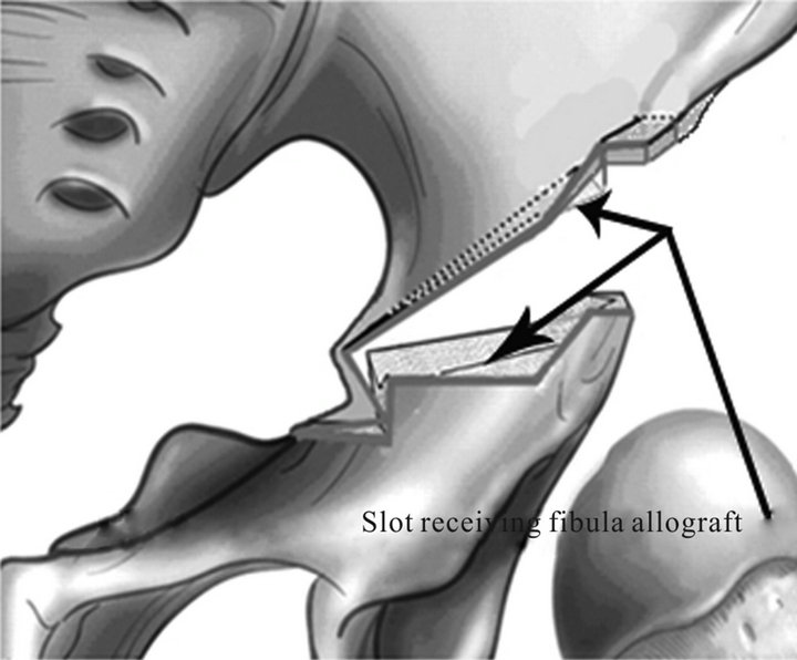 Congenital Dislocation of the Hip in Children between the Ages of One ...