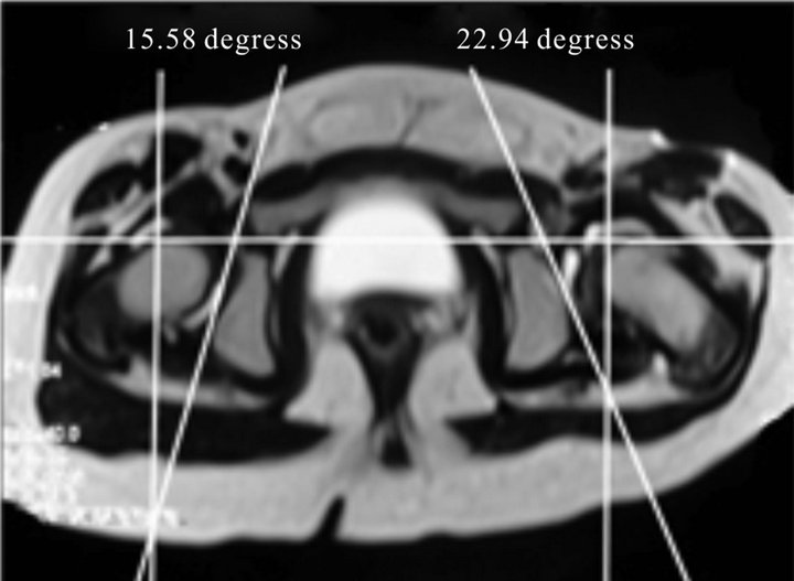 Congenital Dislocation of the Hip in Children between the Ages of One ...