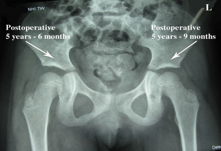 Congenital Dislocation of the Hip in Children between the Ages of One ...