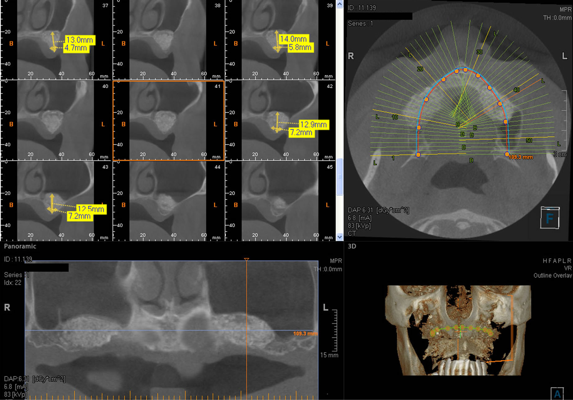 A simple method for repairing membrane sinus perforation