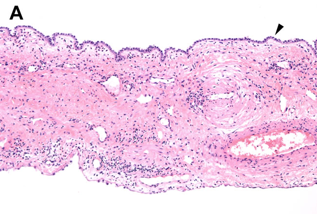 Surgical Resection of a Rapidly Growing Giant Pericardial Cyst: A Case ...