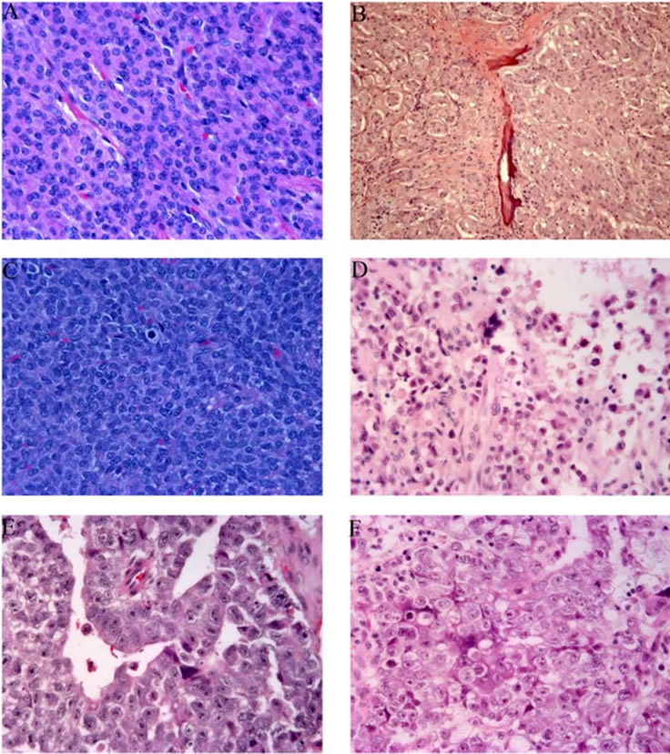 Gynecomastia: An Uncommon but Important Clinical Manifestation for ...