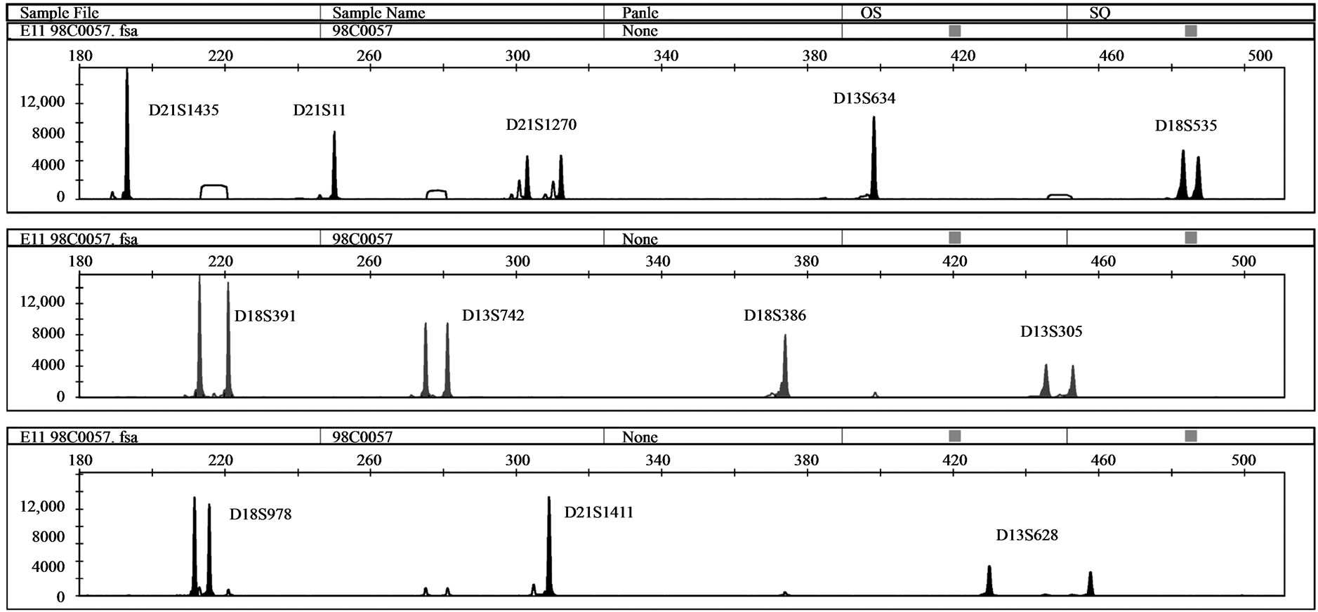 QF-PCR as a molecular-based method for autosomal aneuploidies detection