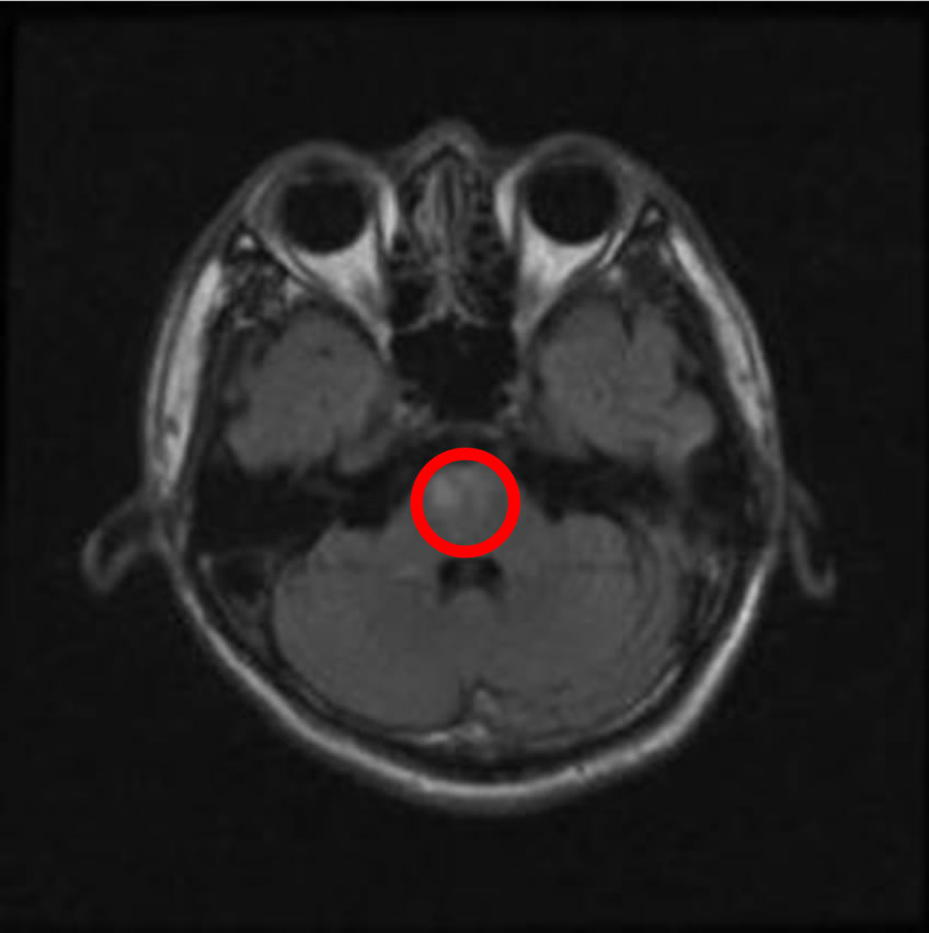 HIV-complicated meningovascular syphilis: Atypical symptoms with ...