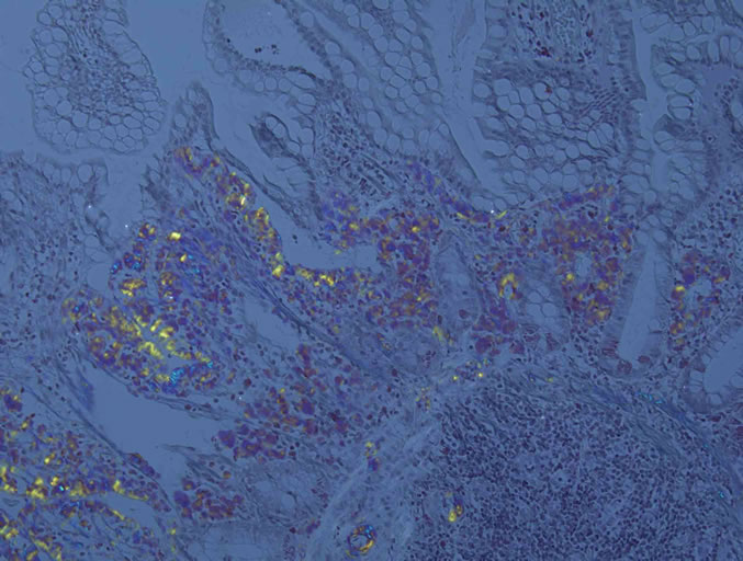 Clinical management of gastrointestinal amyloidosis