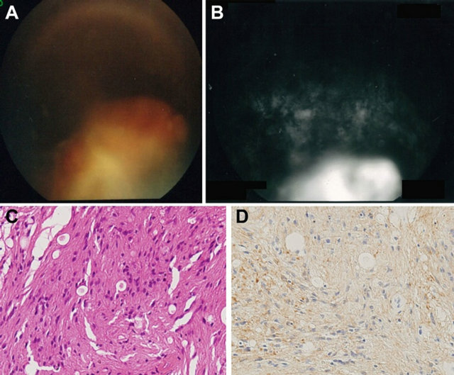Solitary Retinal Astrocytoma: A Case Series
