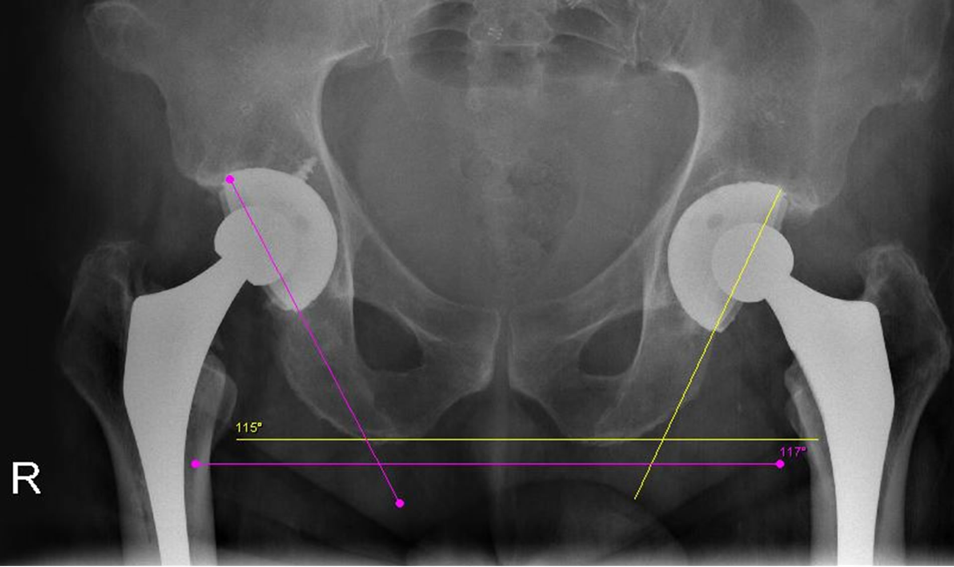Treatment of Bilateral Recurrent Dislocation of Hip Pros-thesis with ...
