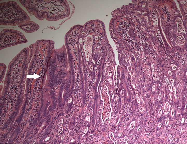 Primary Small Bowel Tumour Presenting as Bowel Obstruction in a Patient ...