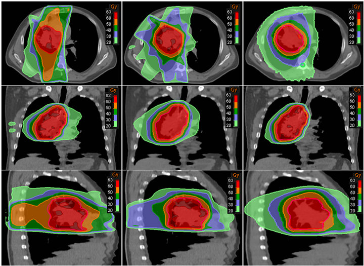 Planning and Dosimetric Comparisons of IMRT Lung Cancers with Three ...
