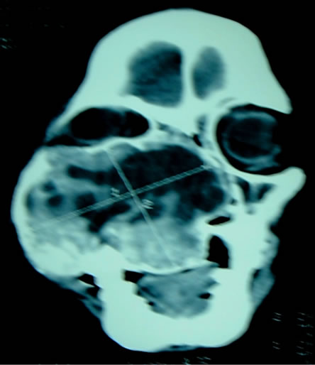Giant cemento-ossifying fibroma—A case report and review of literature