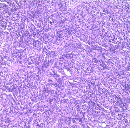 Giant cemento-ossifying fibroma—A case report and review of literature