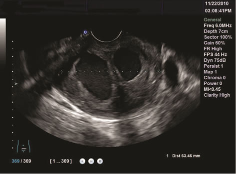 Recurrent Prolapsed Giant Uterine Polyp Comprised of Adenomyotic Cysts