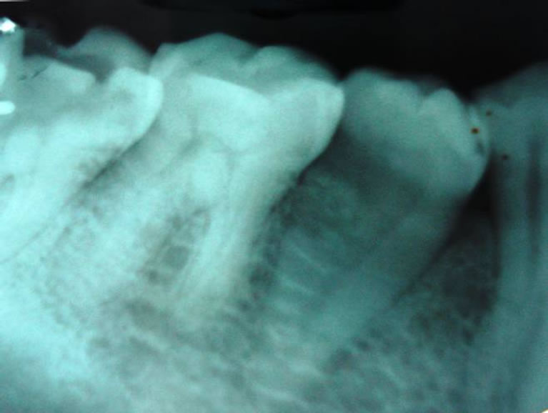 Bilateral double teeth—A case report