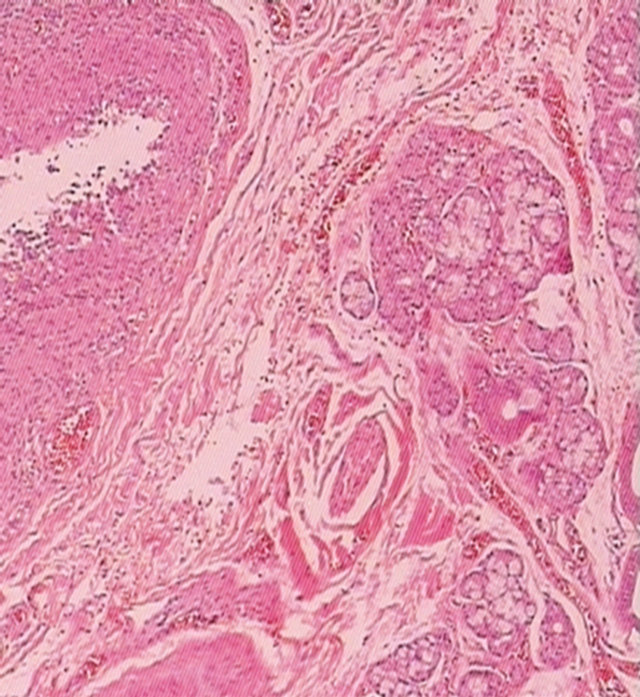 Plunging ranula: An interesting case report