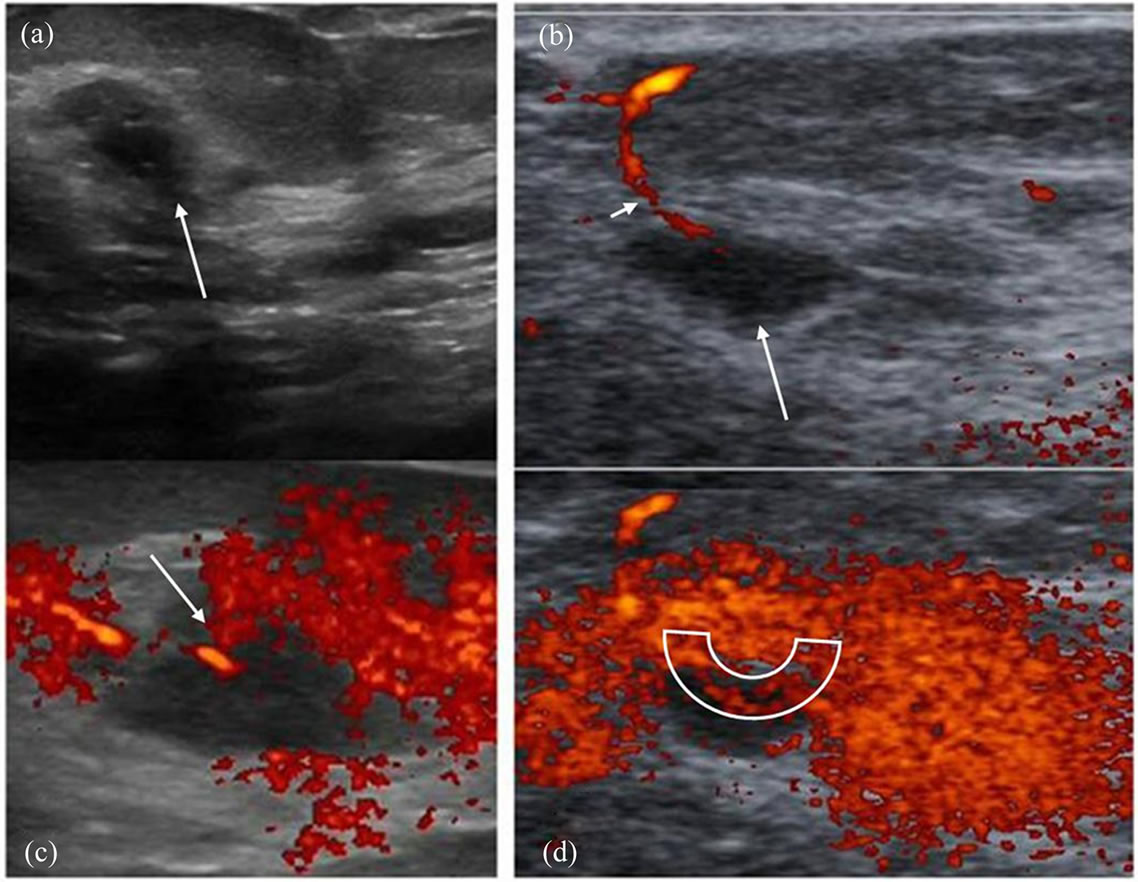 Power Doppler Vocal Fremitus Breast Sonography: Differential Diagnosis ...