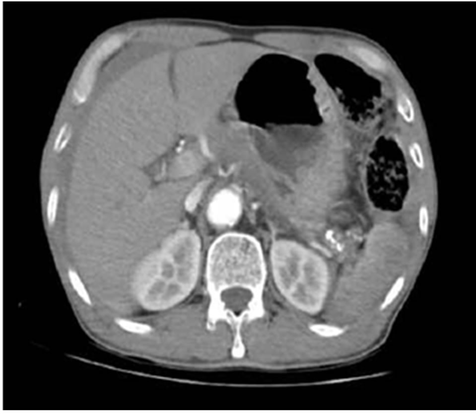 Very Unusual Presentation of Pancreatic Cancer Revealed by Traumatic ...