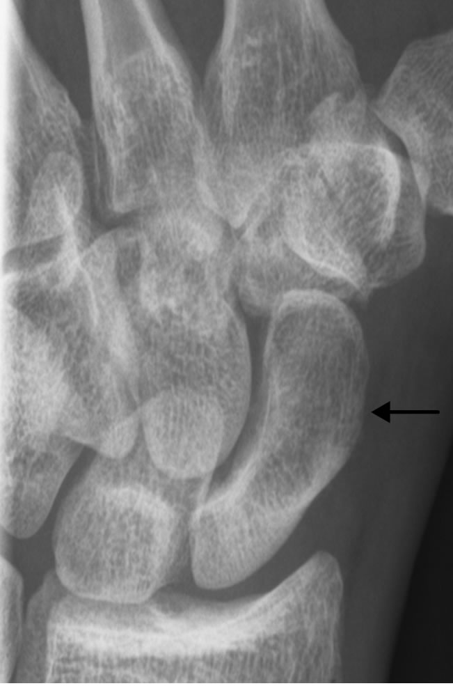 Efficacy of high resolution computed tomography for detection of early ...