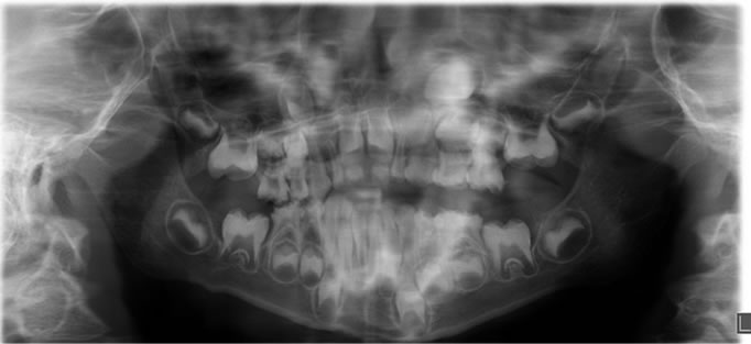 Hypocalcified autosomal recessive amelogenesis imperfecta—A case report