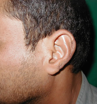 Reconstruction of Partial Auricular Defects by Polypropylene Mesh Helix ...