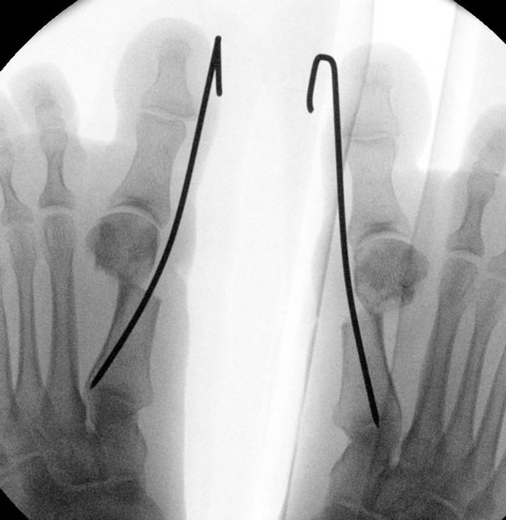 Minimally Invasive Surgery of the Forefoot: Current Concept Review