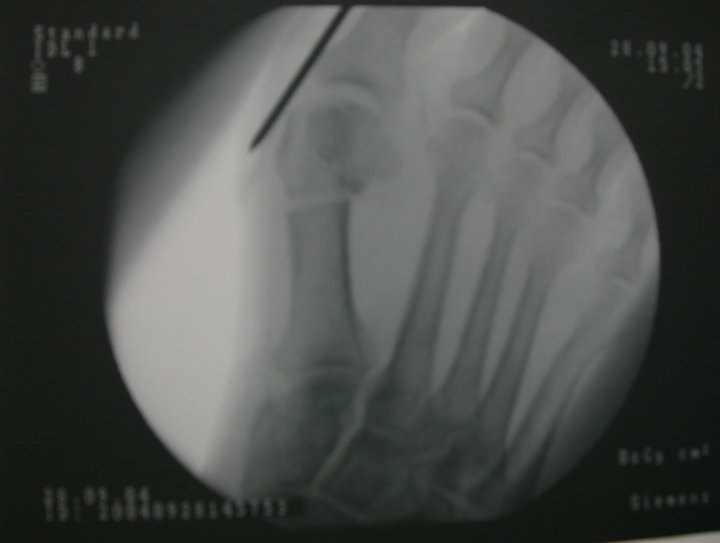 Minimally Invasive Surgery of the Forefoot: Current Concept Review