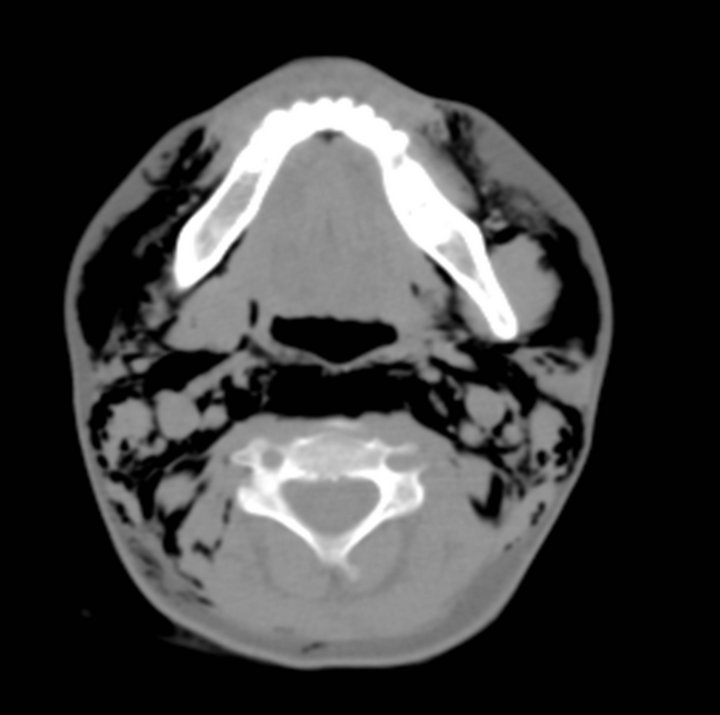 Cervico-Facial Soft Tissue Emphysema with Pneumo-Mediastinum Following ...