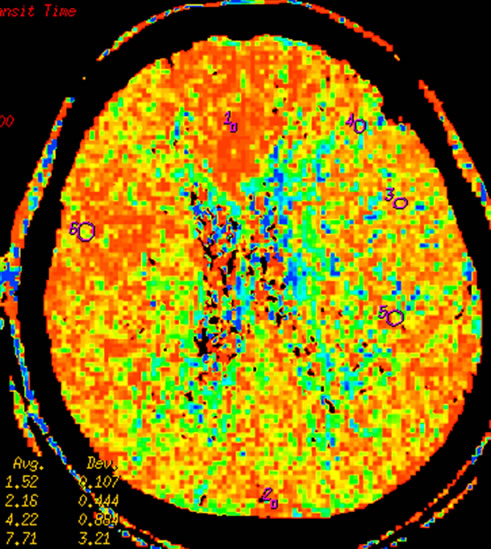Subtraction Perfusion CT: A Technical Note