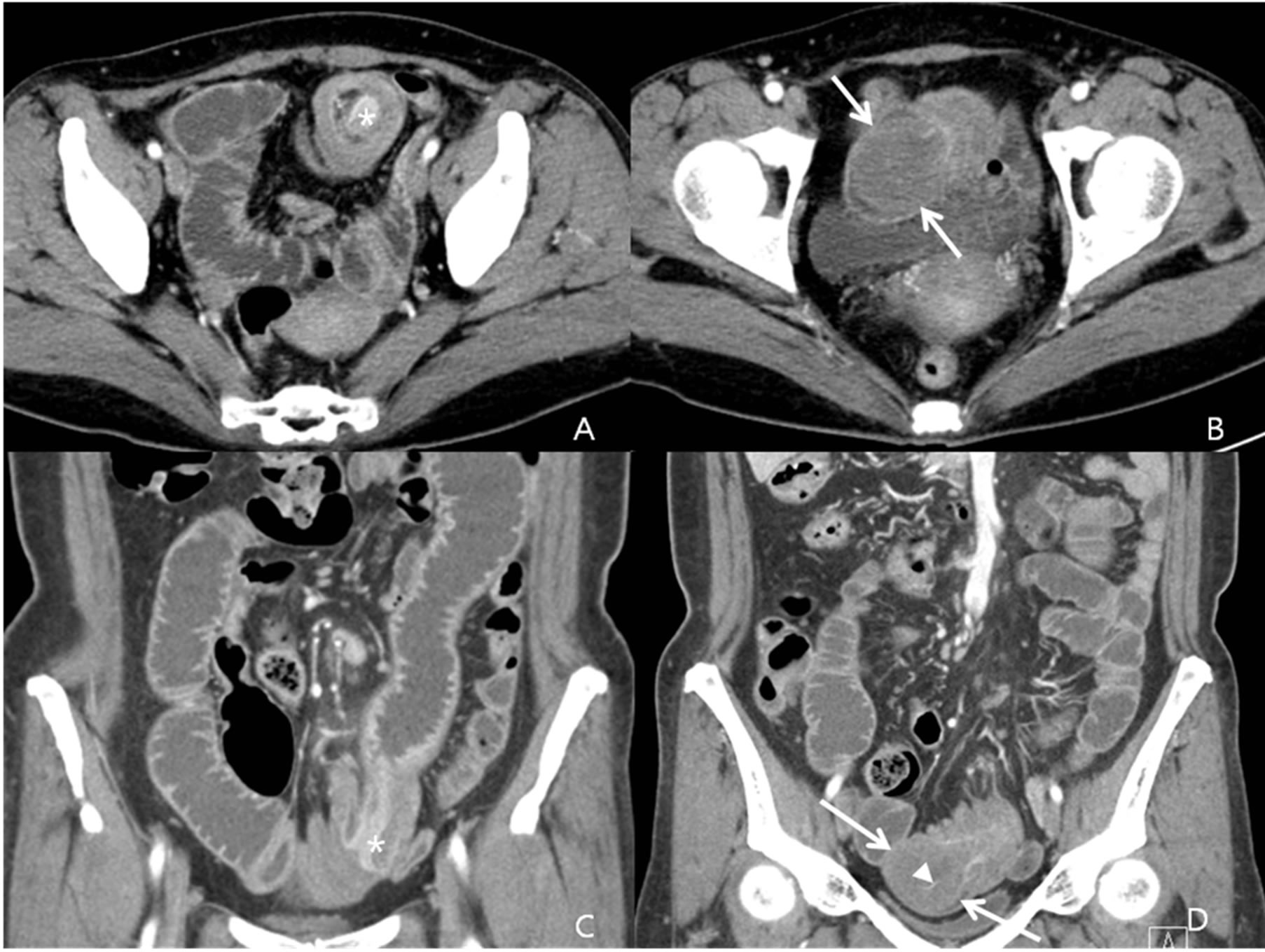 An Inflammatory Fibroid Polyp (Vanek’s Tumor) of the Ileum that ...